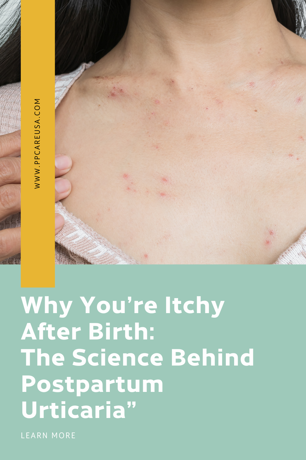 Postpartum Urticaria: Understanding and Managing Hives & Dry Skin After ...
